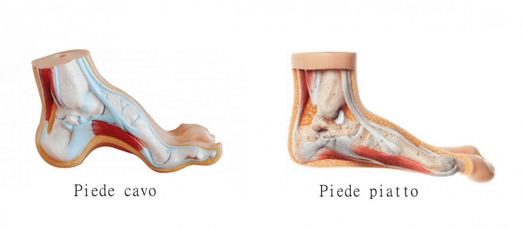 Piede cavo: come capire se hai il piede cavo e come affrontarlo